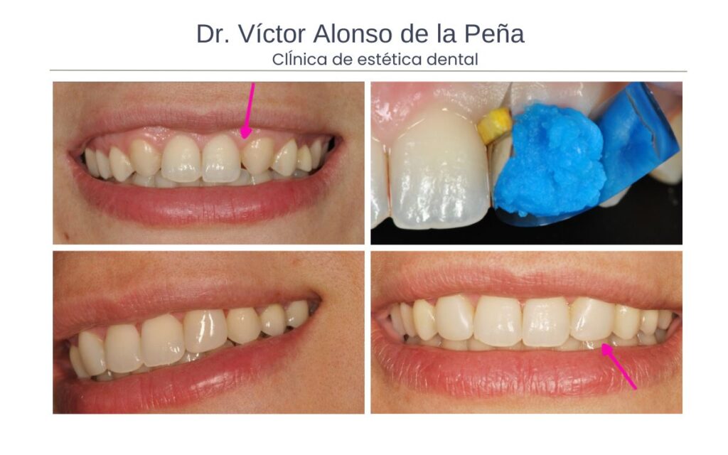 Agenesia dental en dientes definitivos: diagnóstico, prevalencia y ...